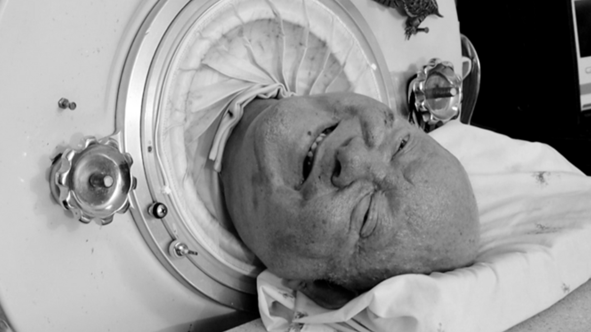 Nie żyje Paul Alexander. Po zakażeniu polio przez 70 lat żył w ...