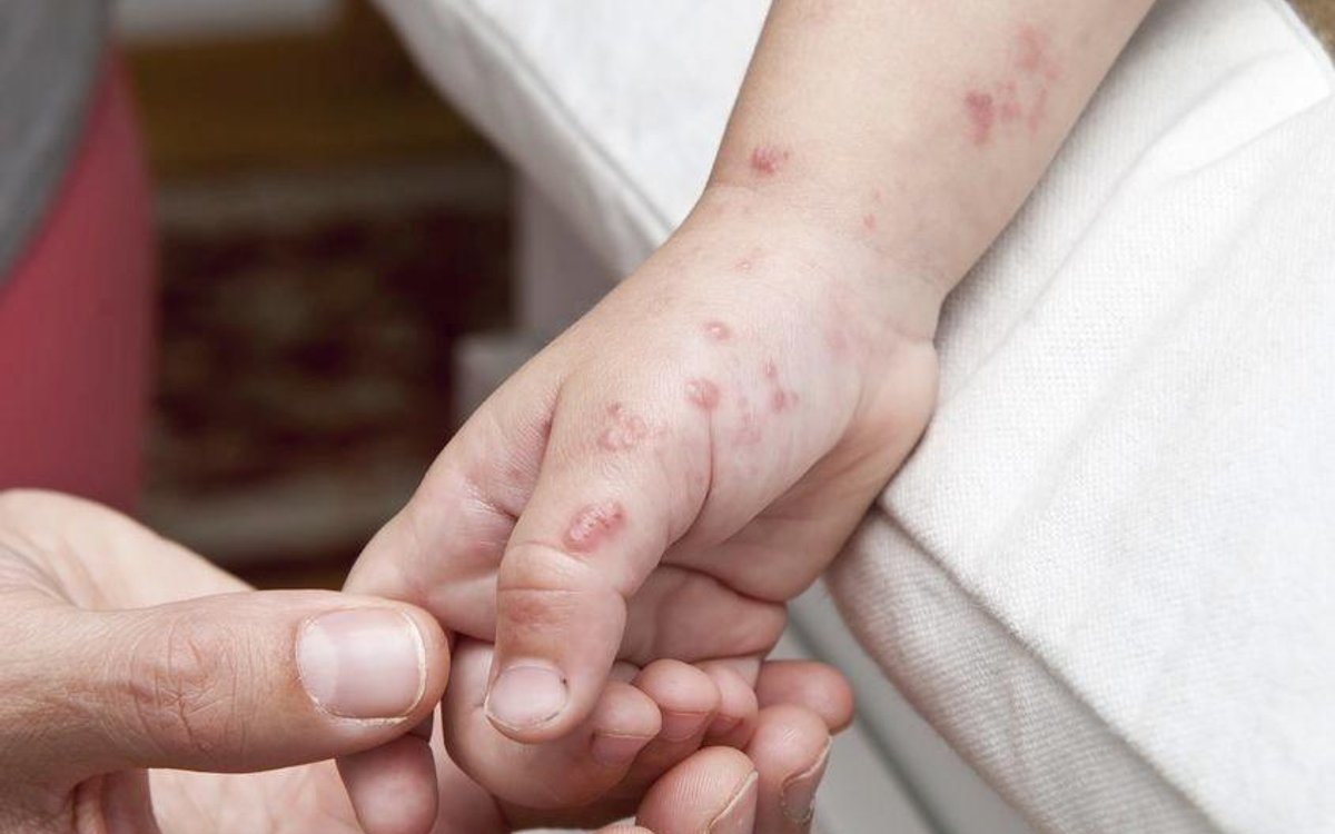 Dziecko zmarło po ospa-party - rp.pl