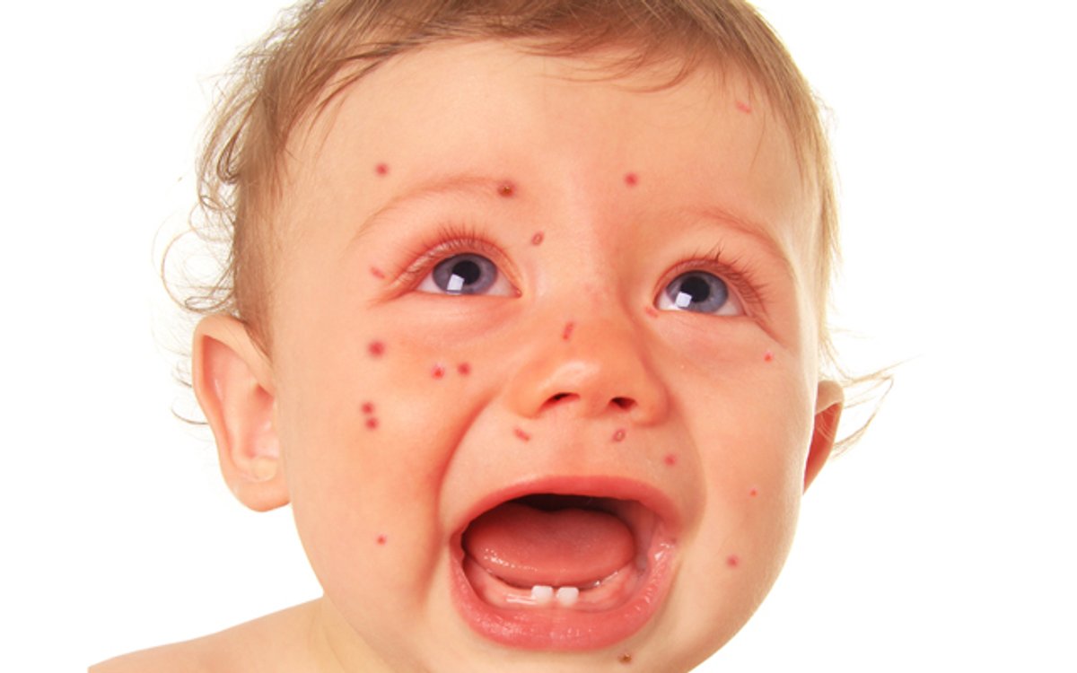 GIS ostrzega przed „ospa party” i „odra party” - rp.pl