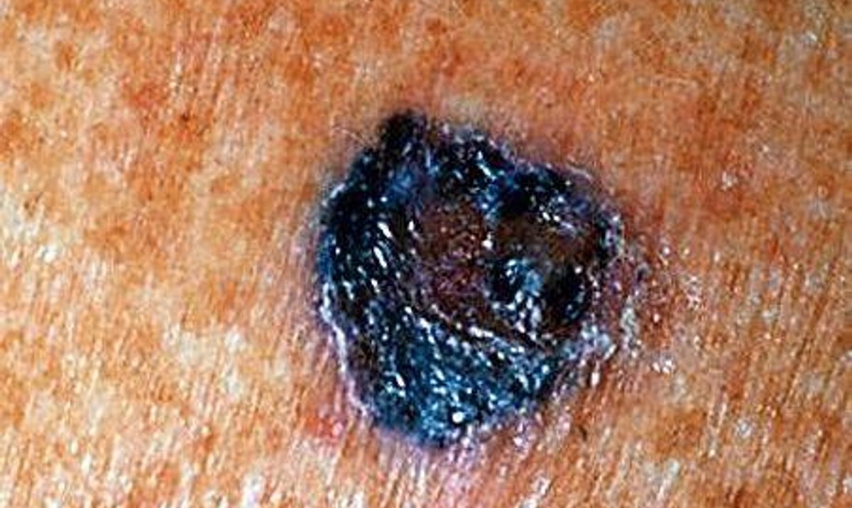 Nowy lek na raka skóry - rp.pl